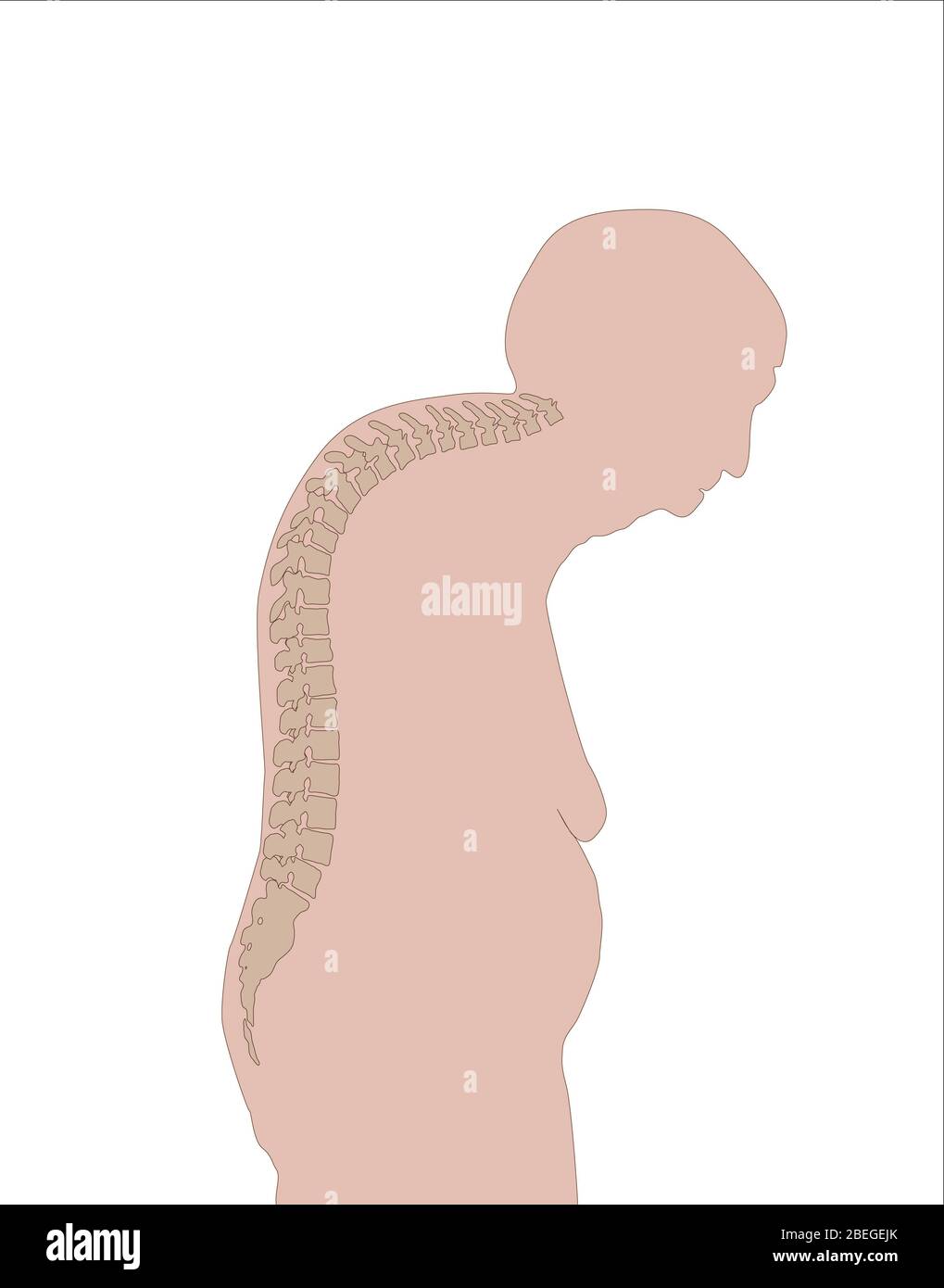 Bone loss hi-res stock photography and images - Alamy