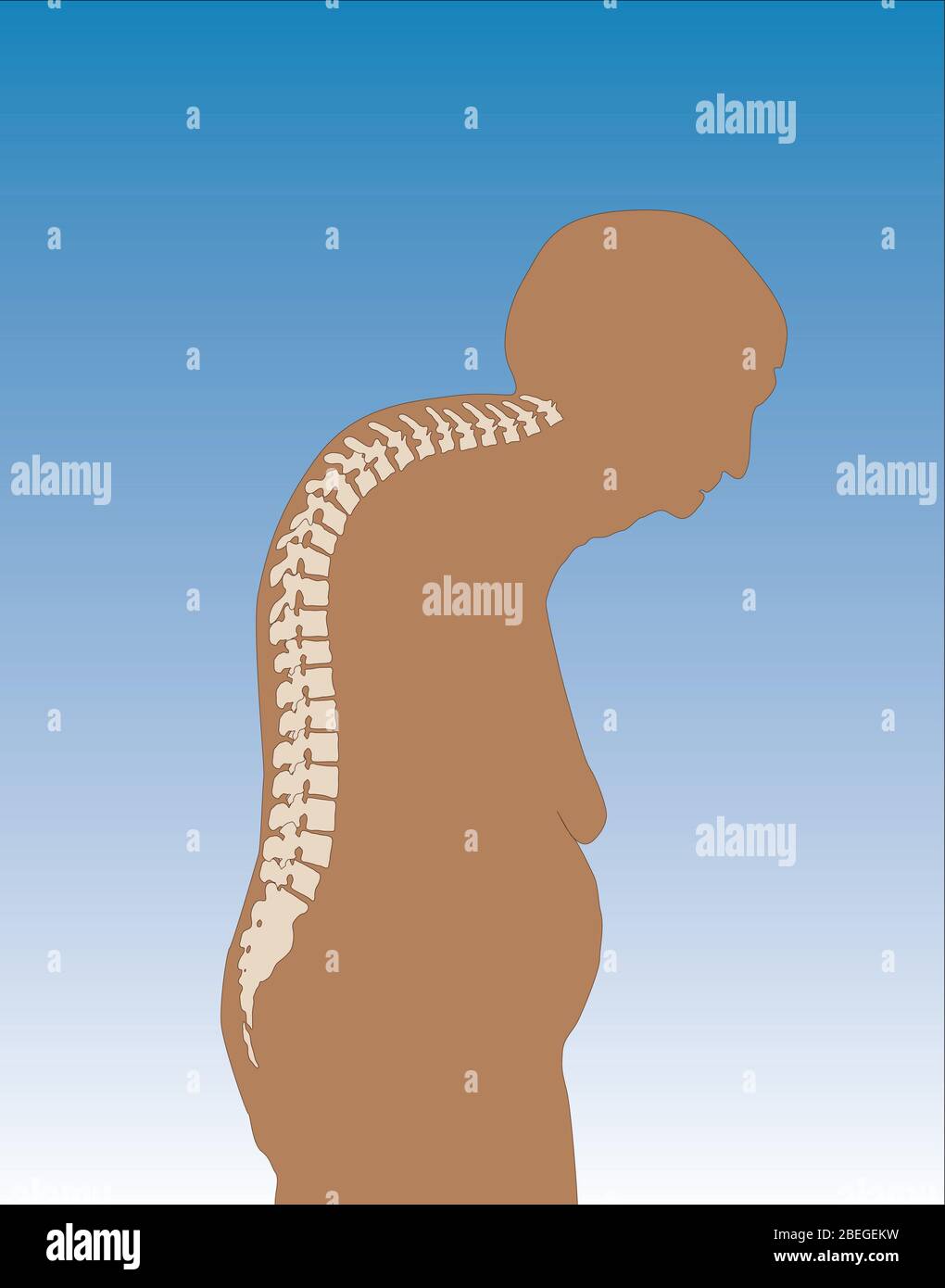 Bone loss hi-res stock photography and images - Alamy
