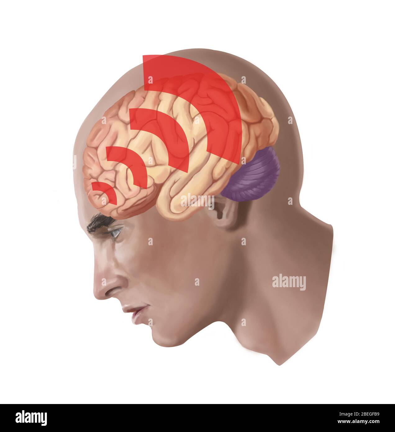 Concussion of the brain hi-res stock photography and images - Alamy