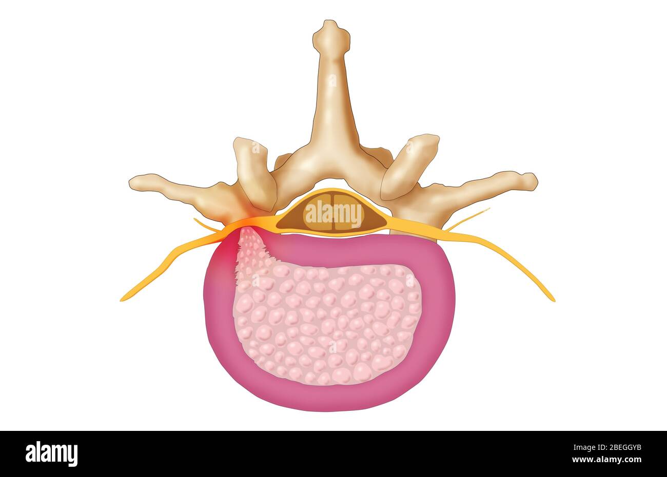 Herniated lumbar disc hi-res stock photography and images - Alamy