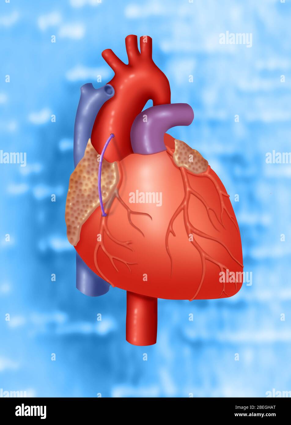 Coronary artery bypass graft hi-res stock photography and images - Alamy