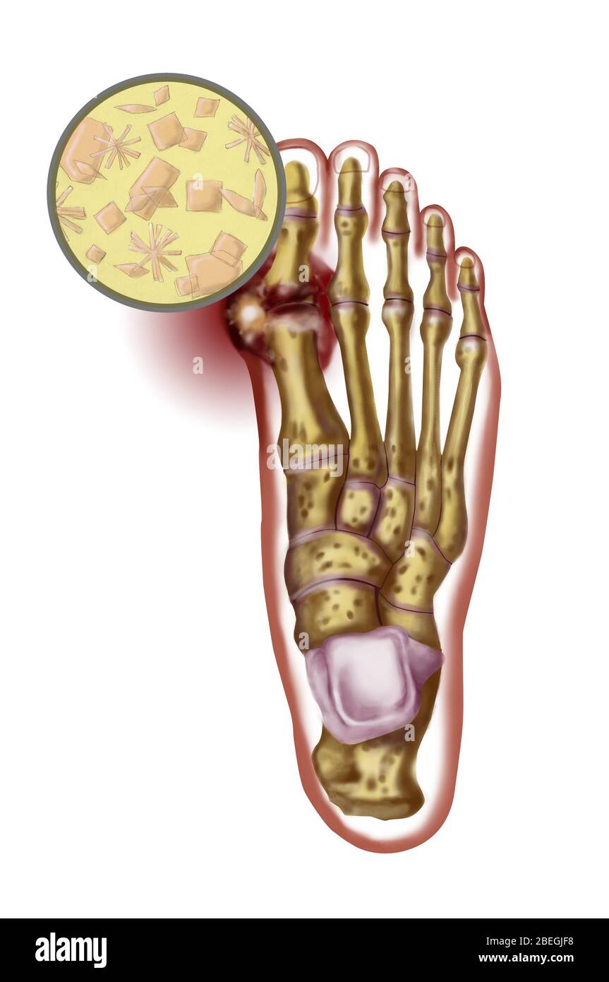 Gout Cut Out Stock Images & Pictures - Alamy