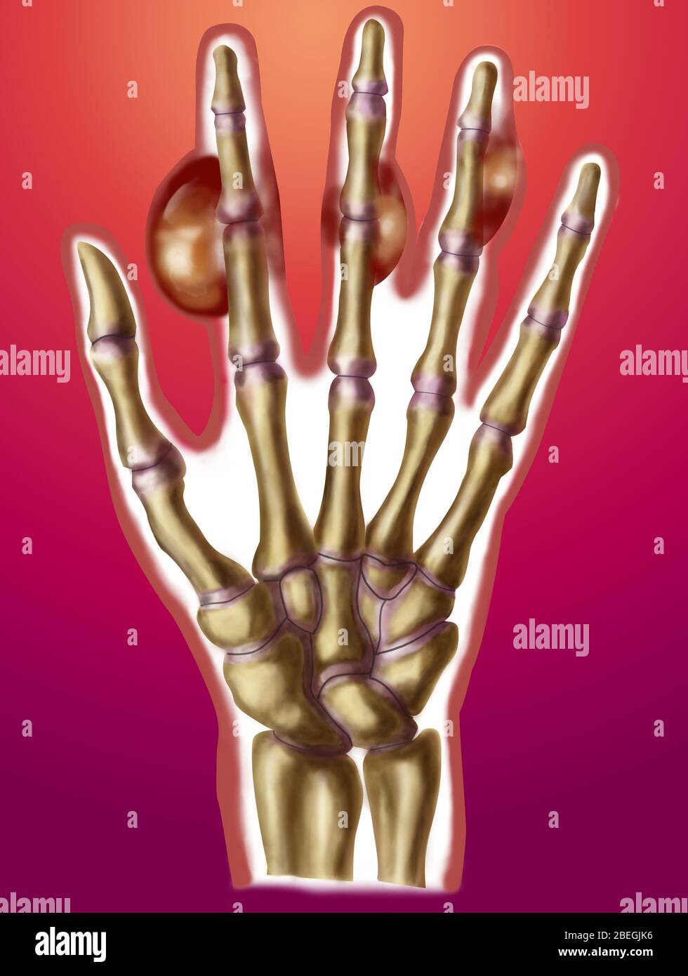 Gout hand hi-res stock photography and images - Alamy