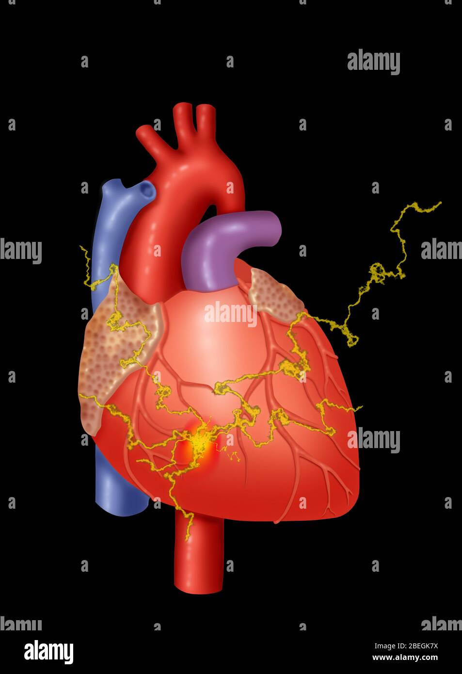 Heart attack illustration hi-res stock photography and images - Alamy