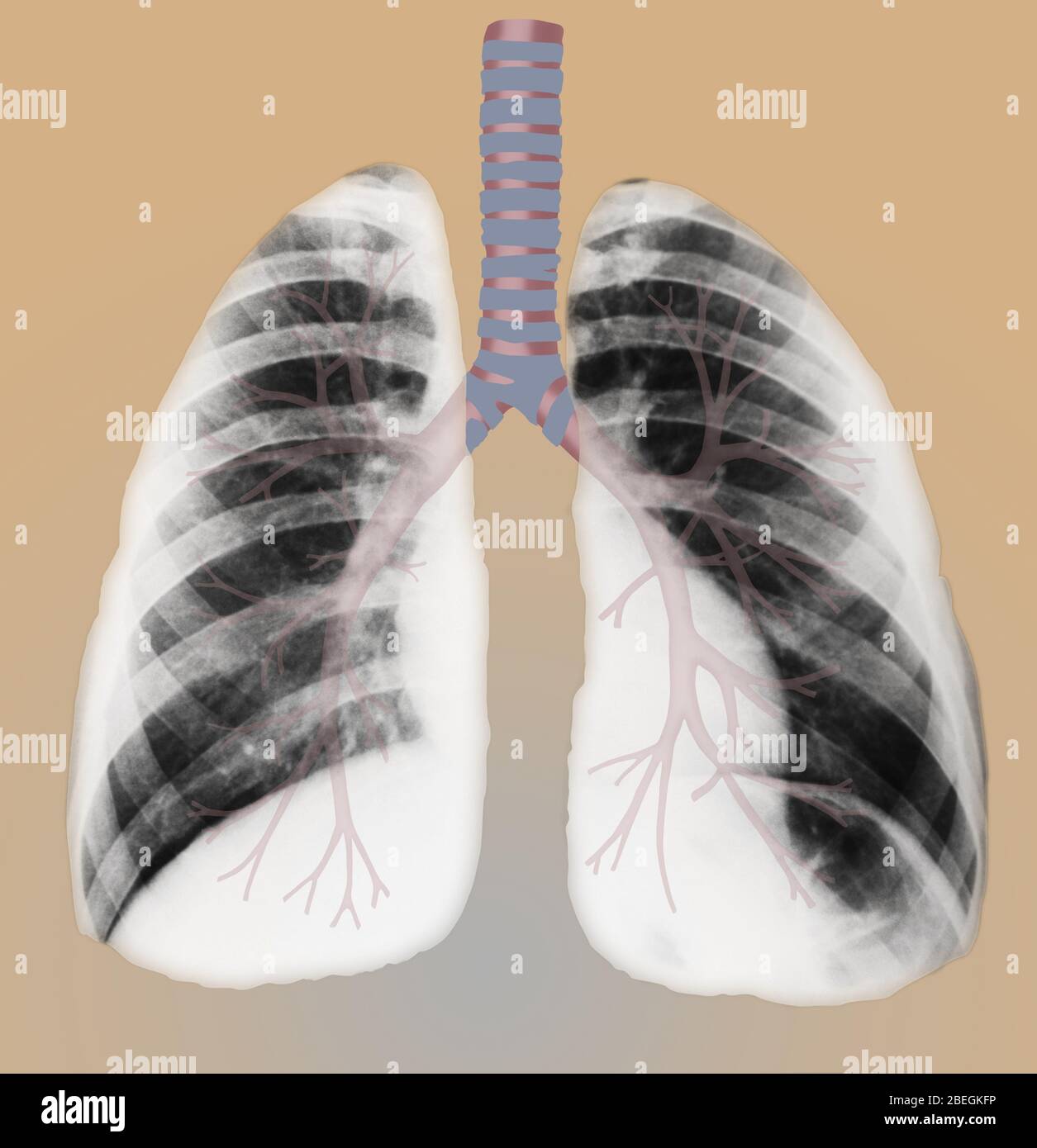 Bronchial Tubes High Resolution Stock Photography and Images - Alamy