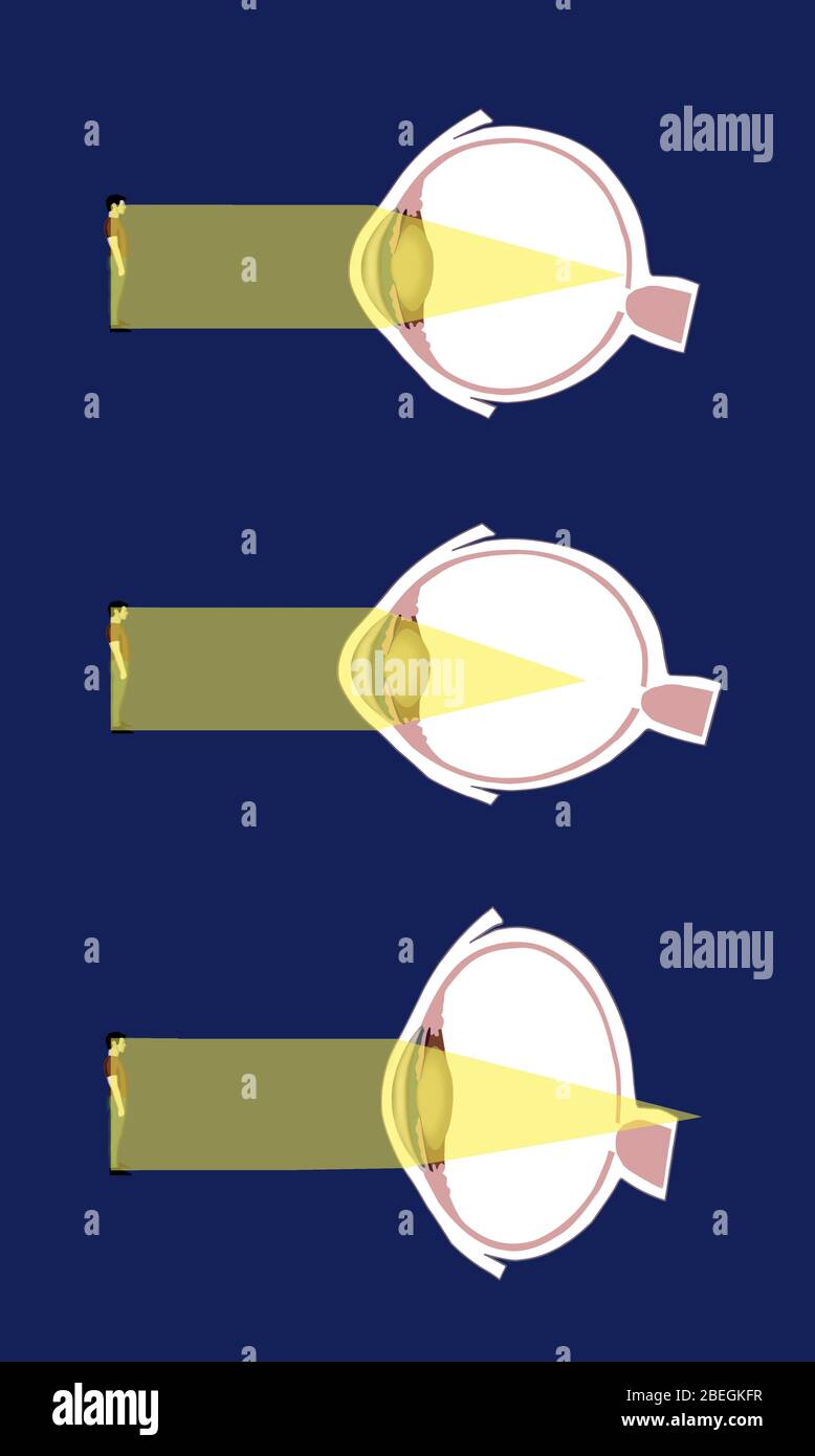 Farsighted High Resolution Stock Photography and Images - Alamy