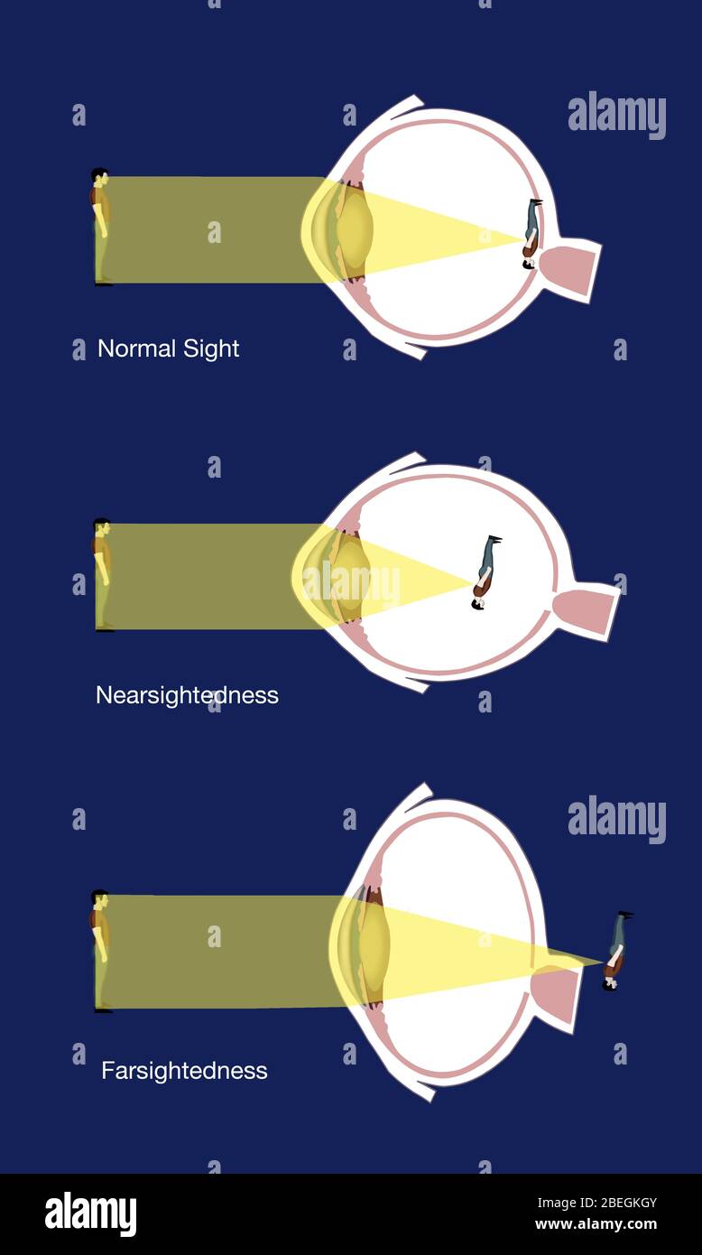 Normal Nearsighted And Farsighted Vision Stock Photo Alamy