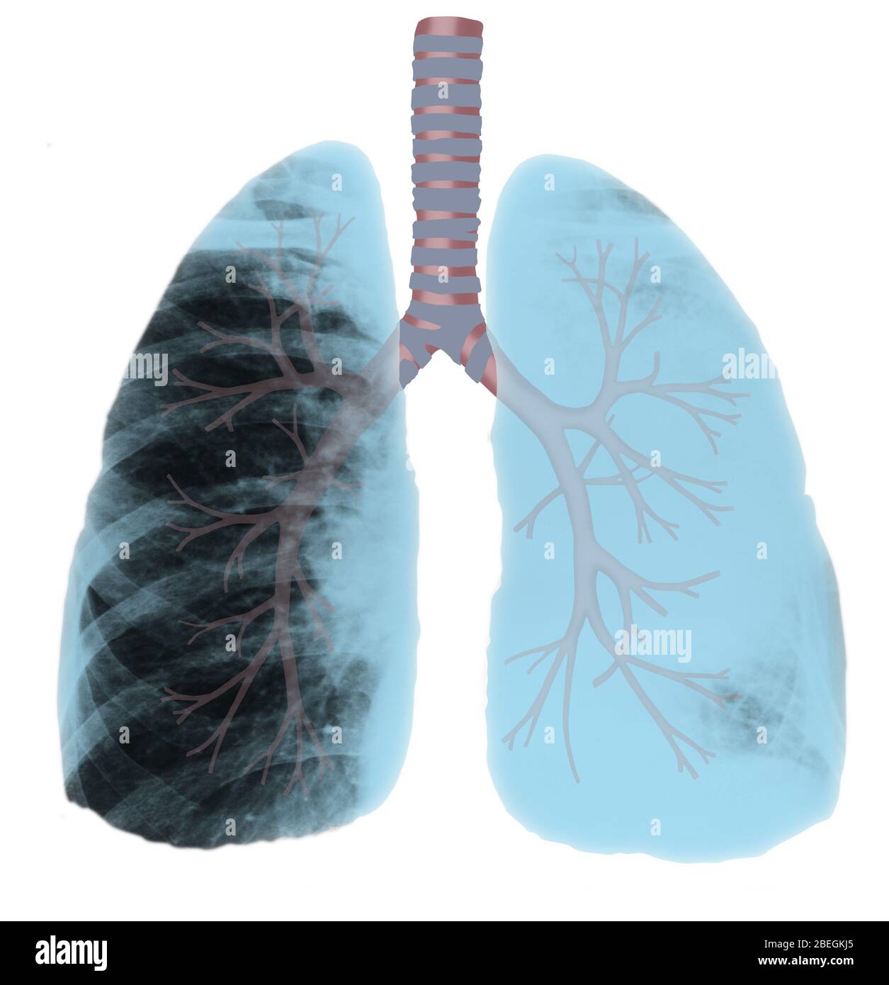 Xray of lung cancer hi-res stock photography and images - Alamy