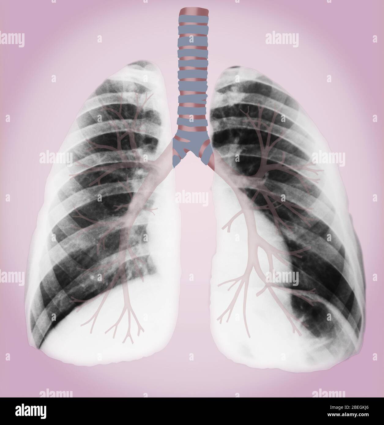 Normal lungs x ray hi-res stock photography and images - Alamy