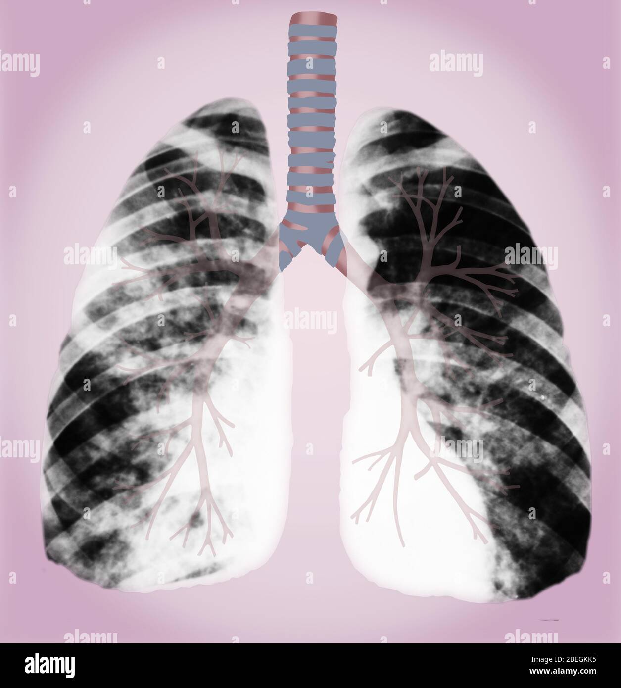 Pneumonia lung hi-res stock photography and images - Alamy