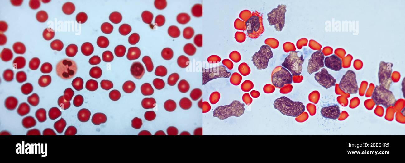 Healthy / Leukemia Blood Comparison Stock Photo - Alamy