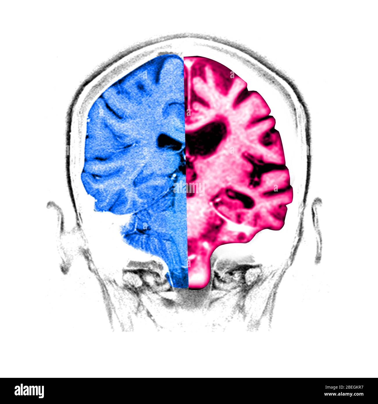 Mri Brain Scan Normal High Resolution Stock Photography and Images - Alamy