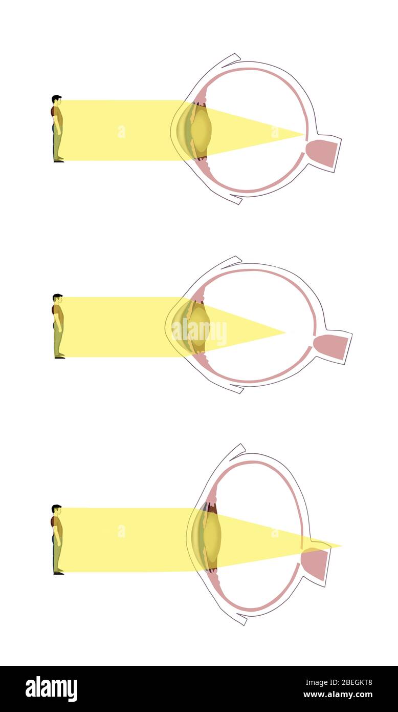 Normal, Nearsighted, and Farsighted Vision Stock Photo - Alamy