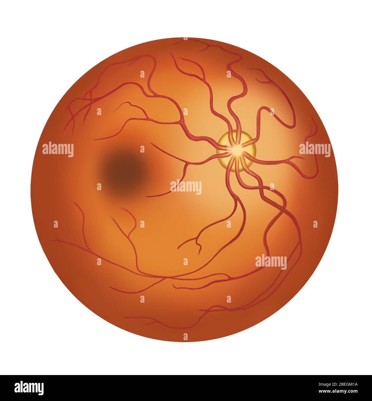 Retinal Hemorrhage Hypertension