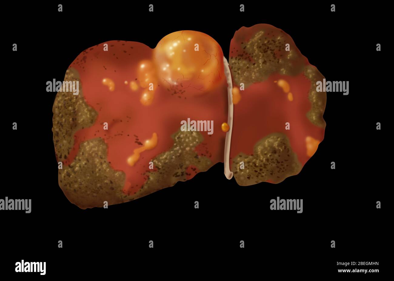 Liver cancer illustration hi-res stock photography and images - Alamy