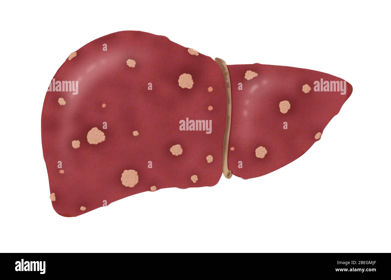 Disease liver Cut Out Stock Images & Pictures - Alamy