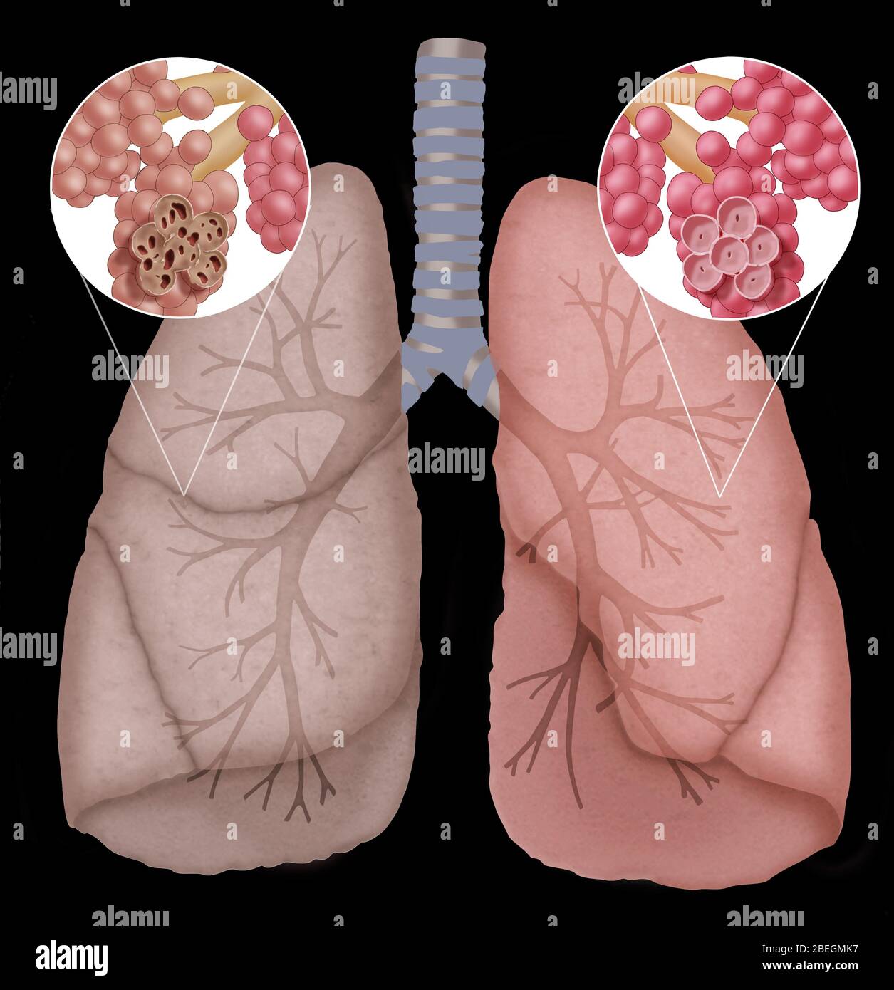 Illustration of Emphysema Stock Photo - Alamy Illustration of Emphysema Stock Photo - Alamy