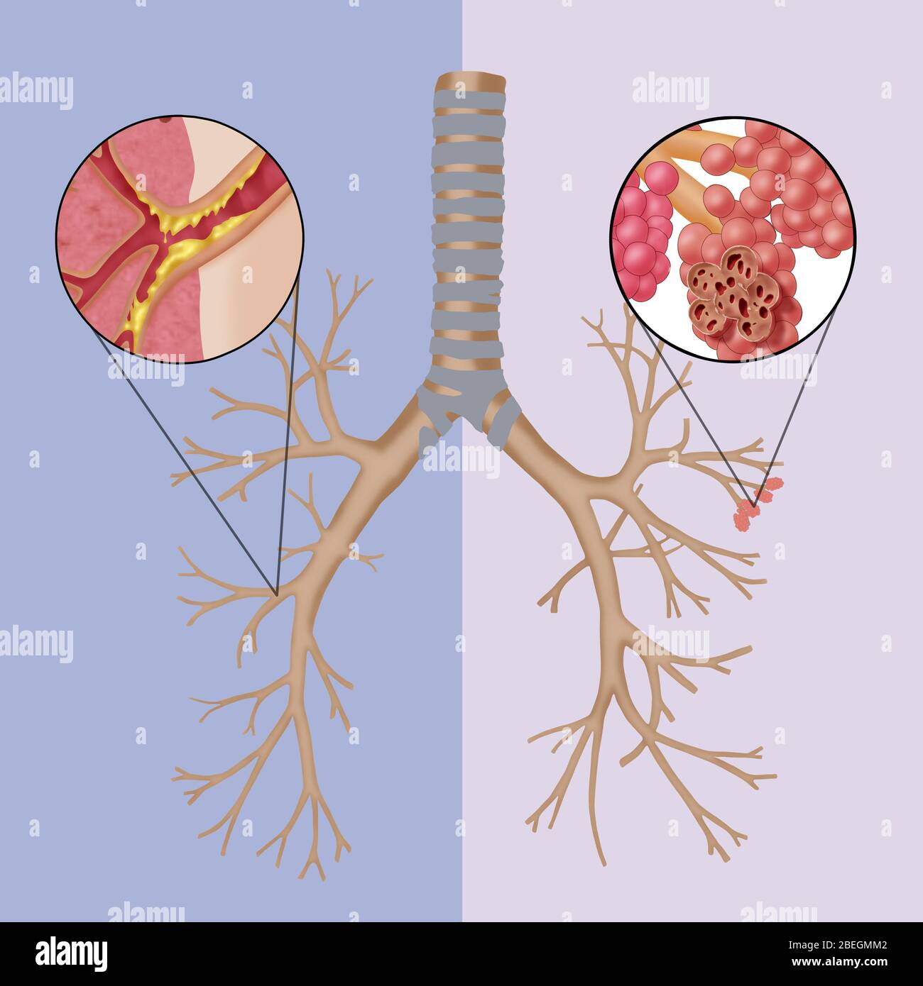 Chronic Obstructive Pulmonary Disease (COPD Stock Photo - Alamy
