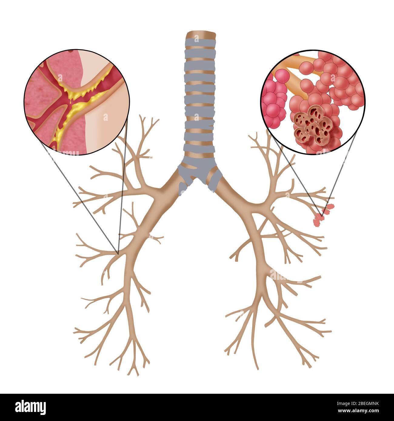 Chronic Obstructive Pulmonary Disease (COPD Stock Photo - Alamy