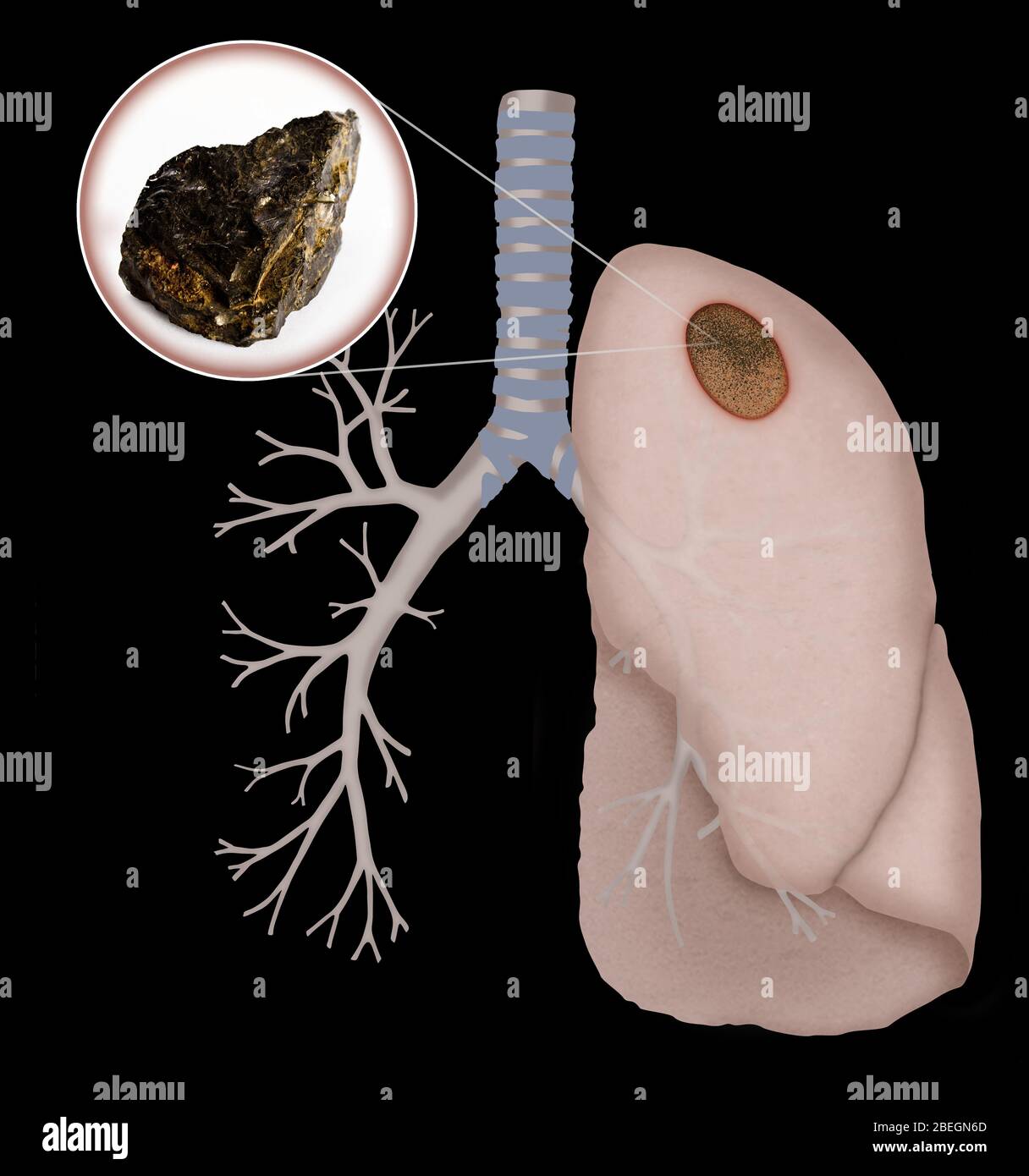 Black lung disease hi-res stock photography and images - Alamy