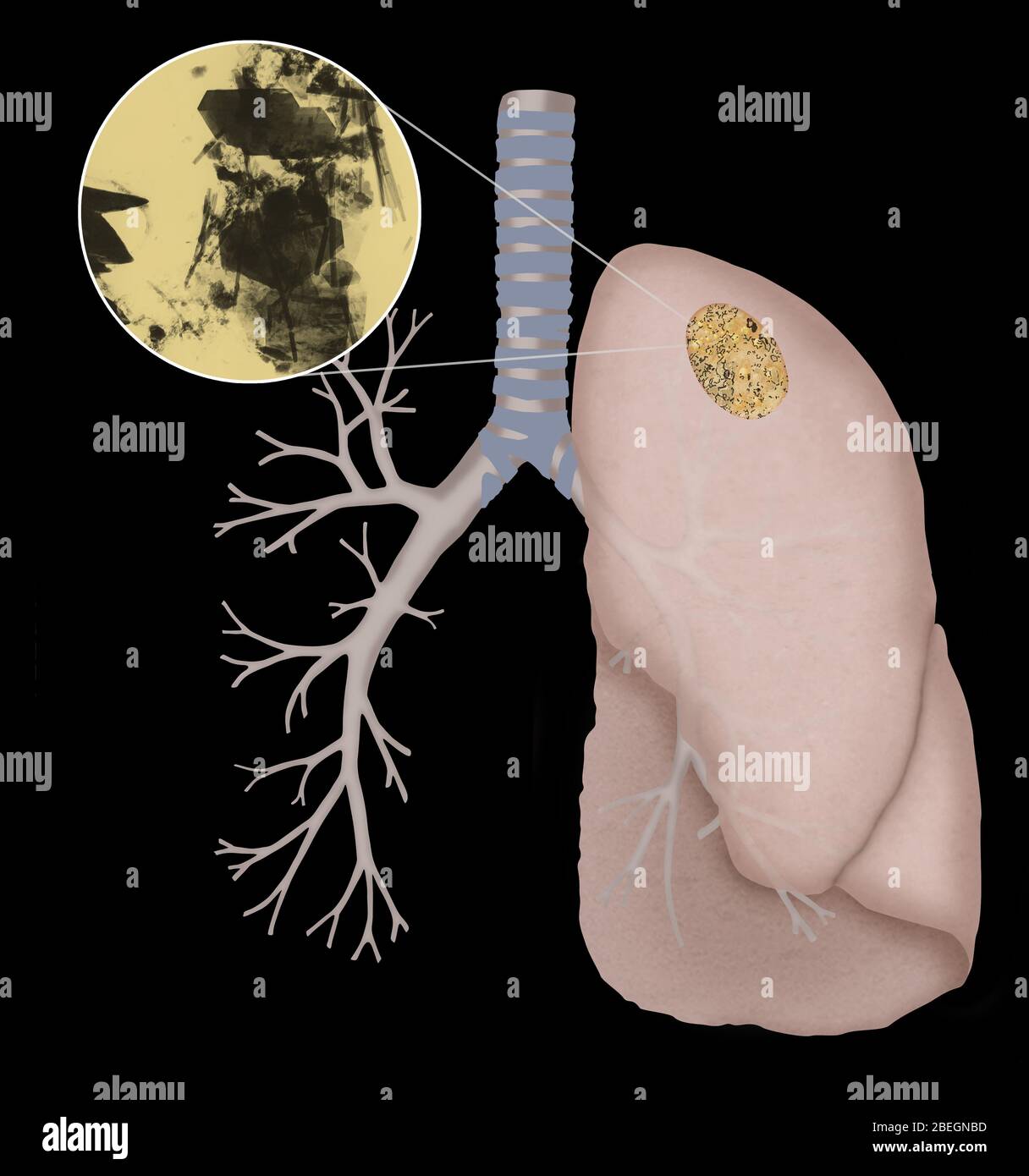 Asbestos particles hi-res stock photography and images - Alamy