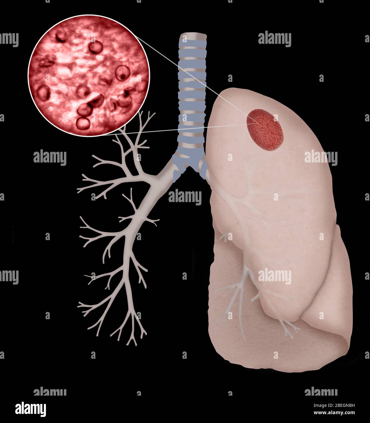 Pneumocystis jirovecii hi-res stock photography and images - Alamy