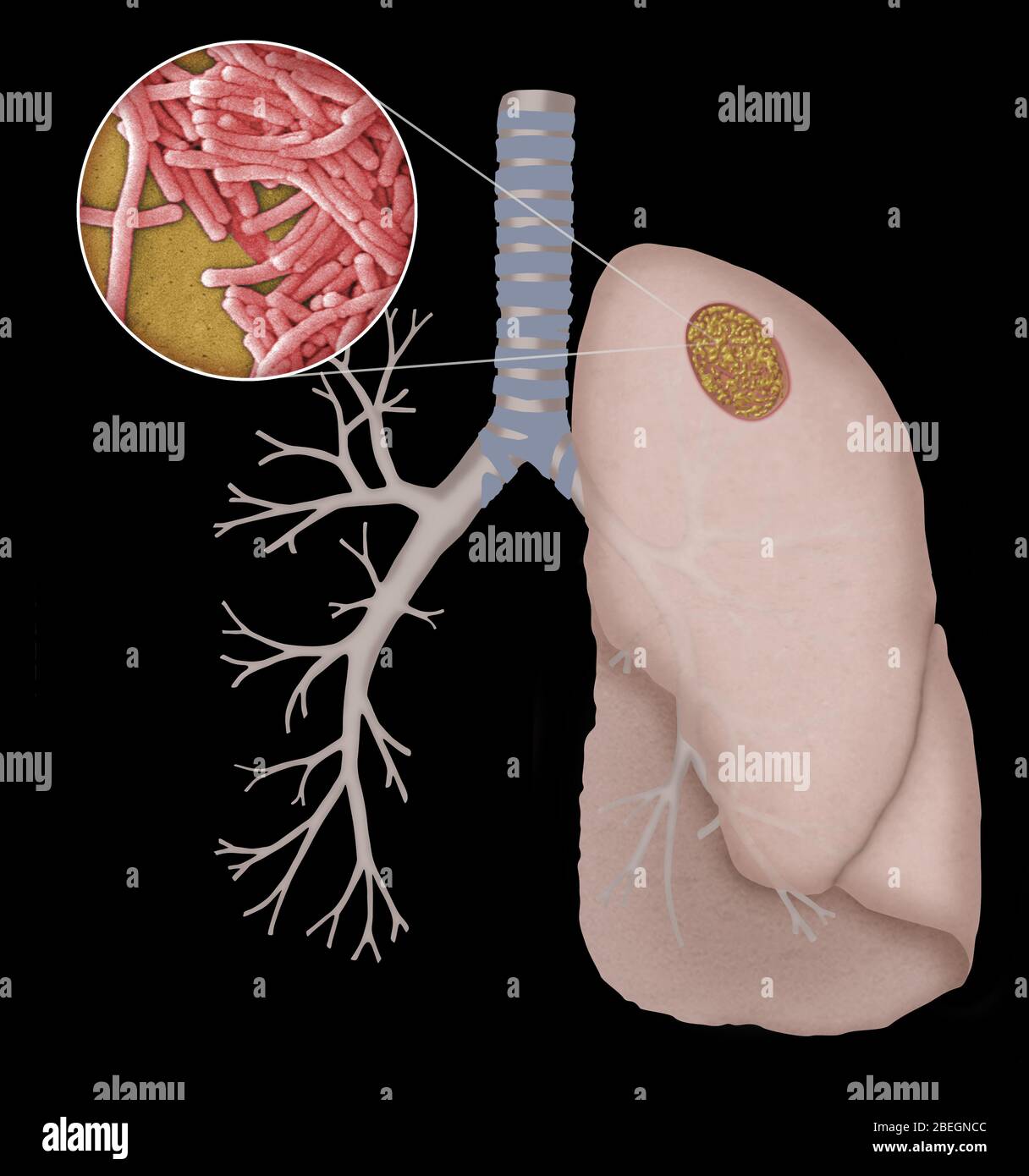 Legionnaires disease hi-res stock photography and images - Alamy