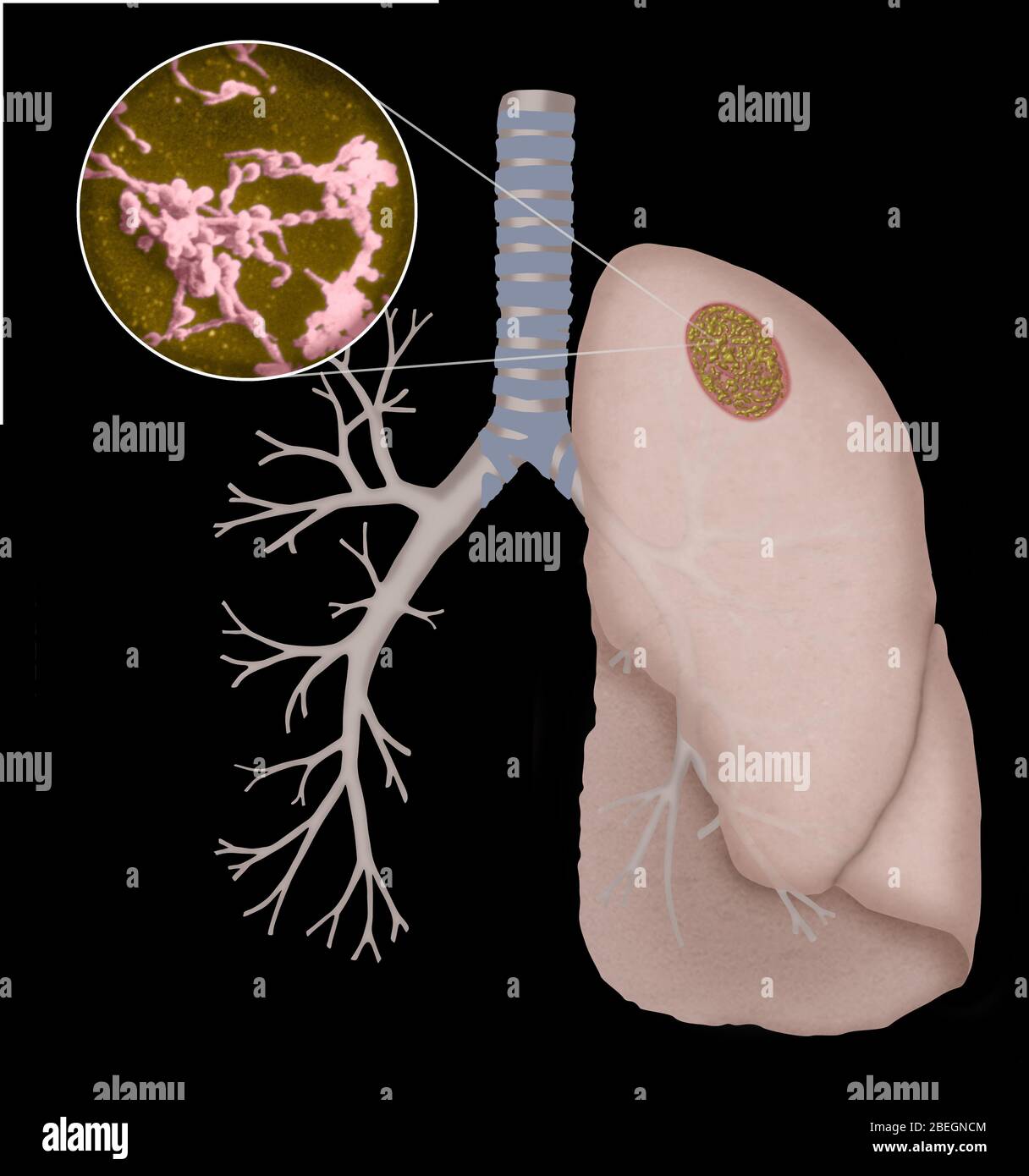 Mycoplasma bacteria hi-res stock photography and images - Alamy