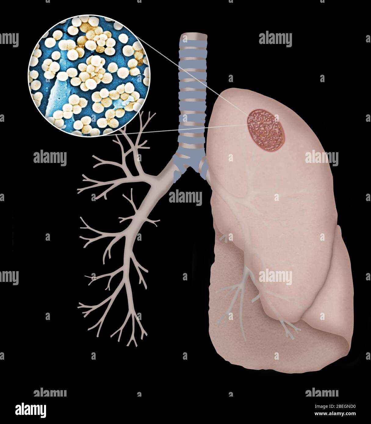 Staph infection hi-res stock photography and images - Alamy