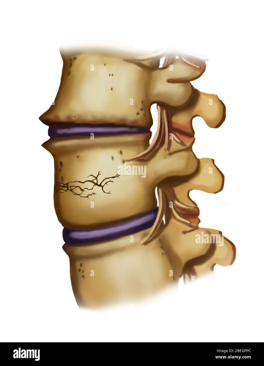 Compression fracture hi-res stock photography and images - Alamy