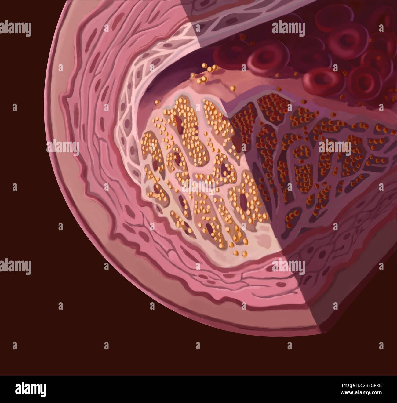 Cholesterol build up hi-res stock photography and images - Alamy