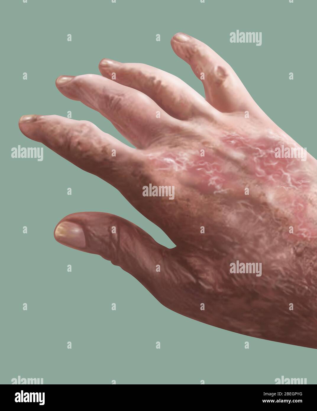 Mild psoriasis hi-res stock photography and images - Alamy