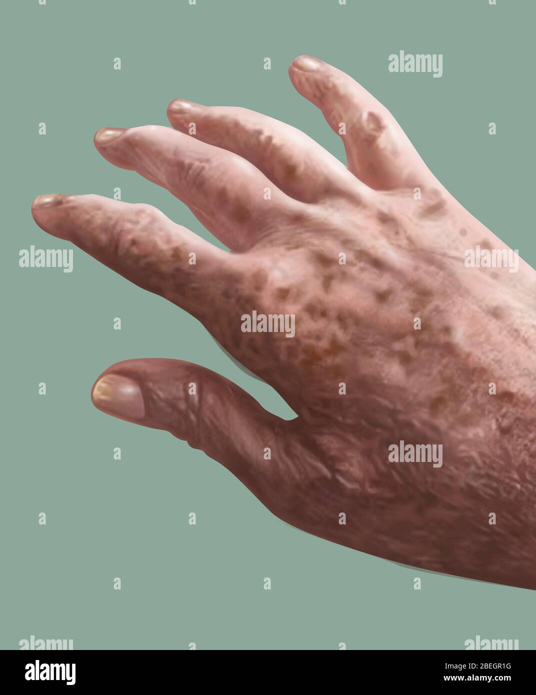 Liver disease skin hi-res stock photography and images - Alamy