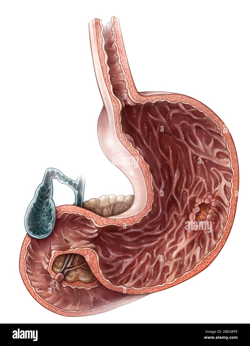 Ulcer wound Cut Out Stock Images & Pictures - Alamy