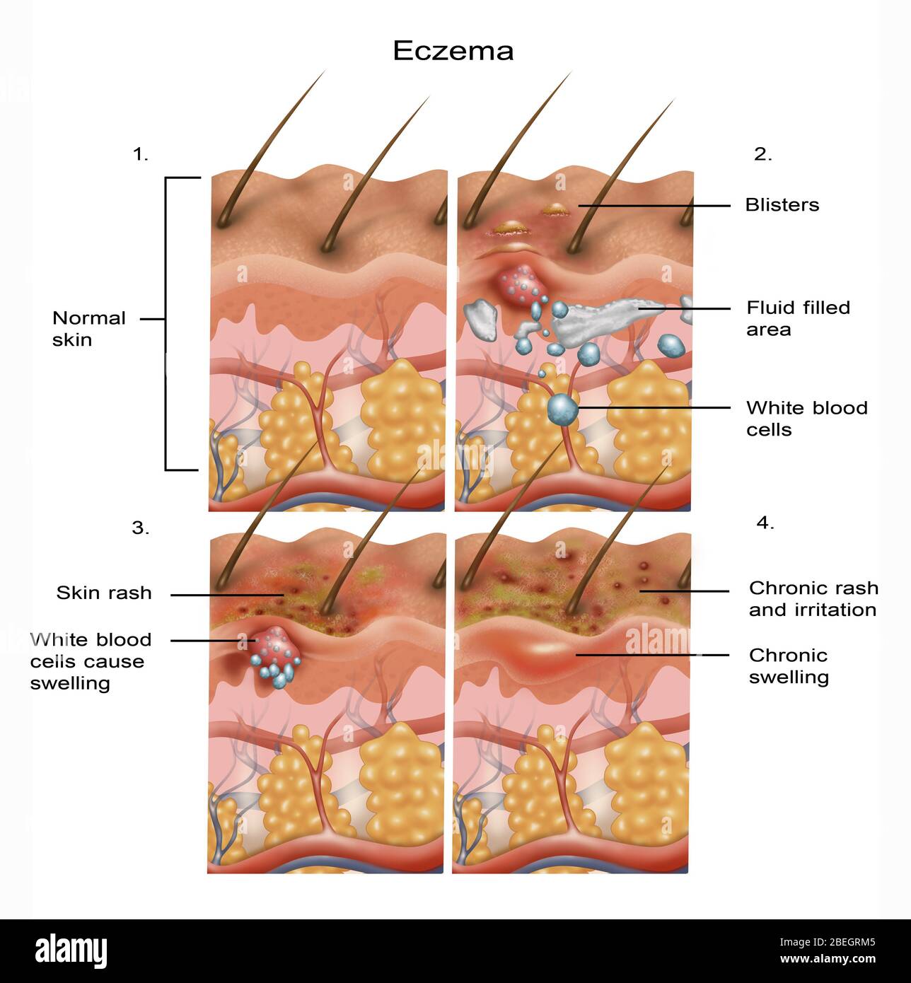 Acute eczema Cut Out Stock Images & Pictures - Alamy