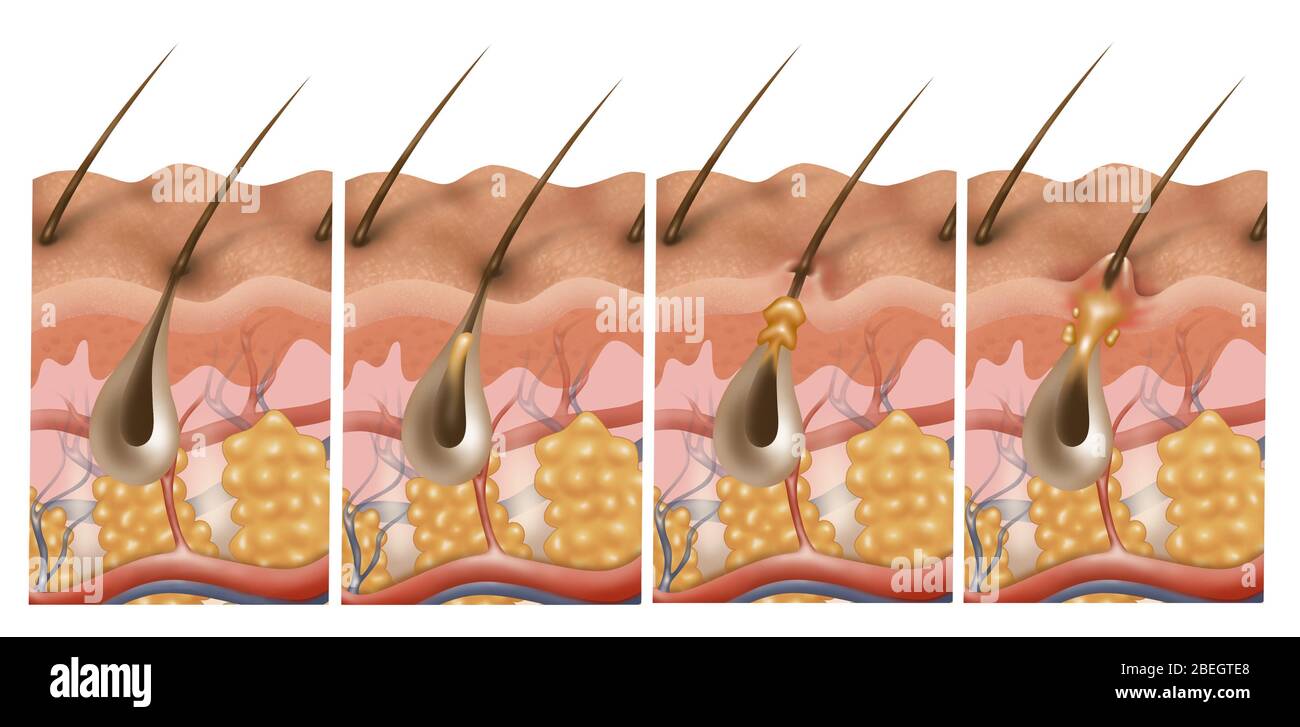 Hair follicles hi-res stock photography and images - Alamy