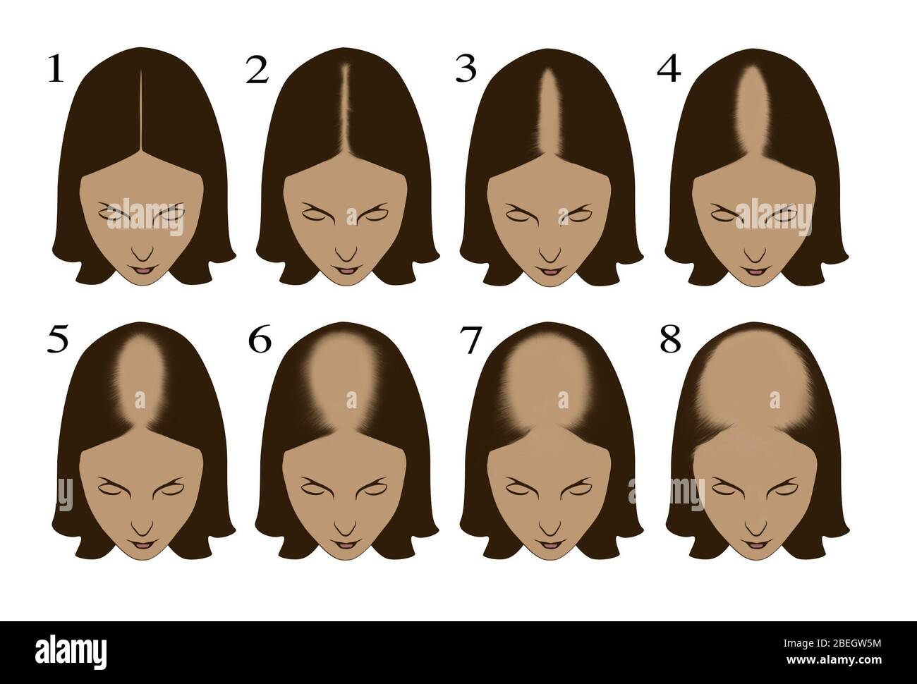 Female hair loss stages hi-res stock photography and images - Alamy