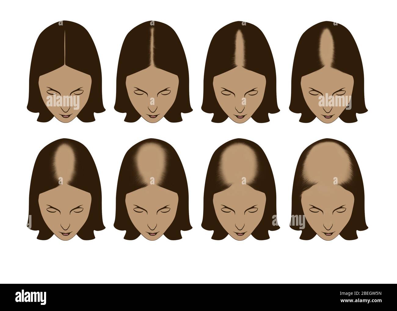 Female pattern hair loss hi-res stock photography and images - Alamy
