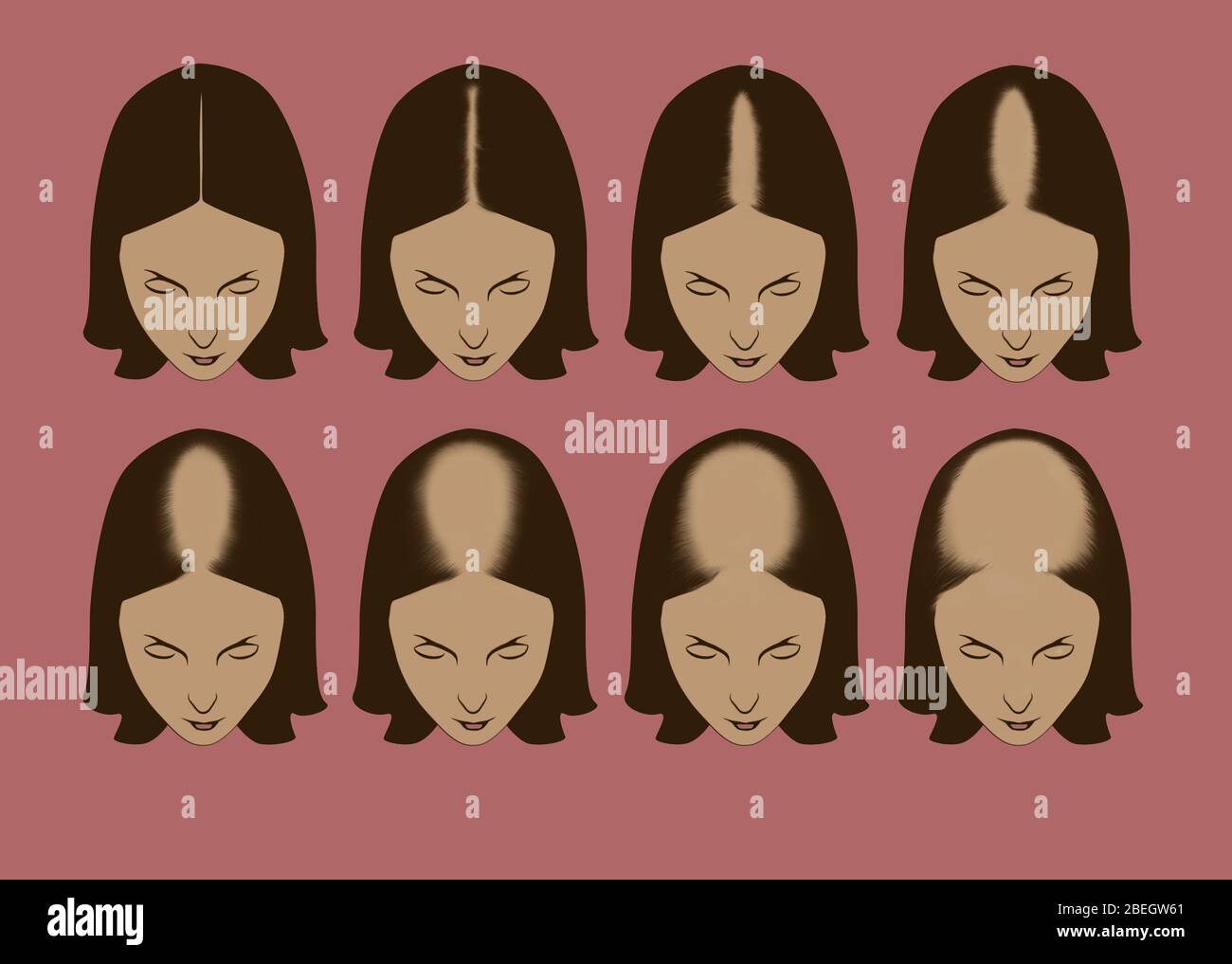 Female hair loss stages hi-res stock photography and images - Alamy