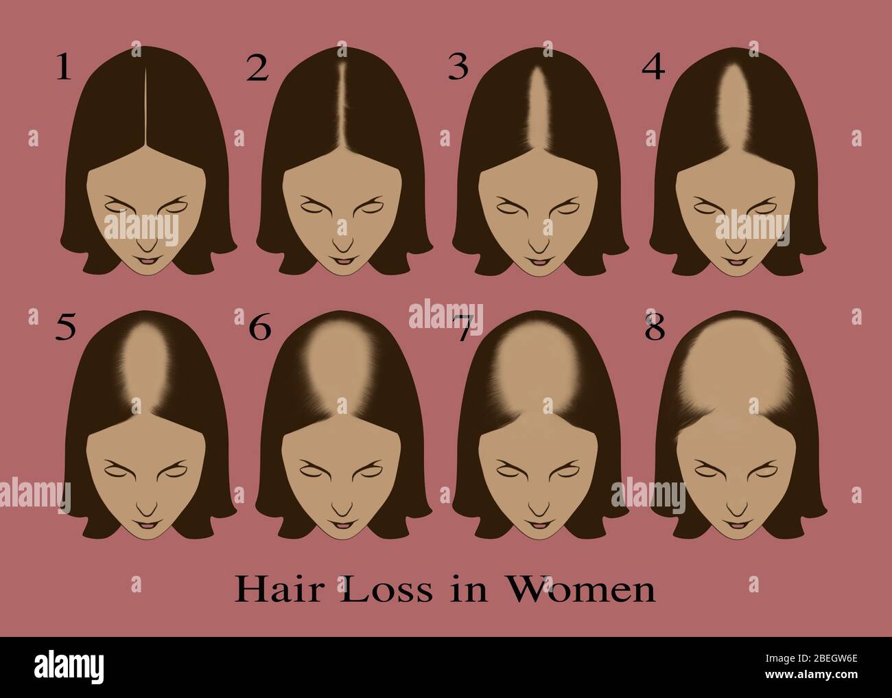 Female hair loss stages hi-res stock photography and images - Alamy
