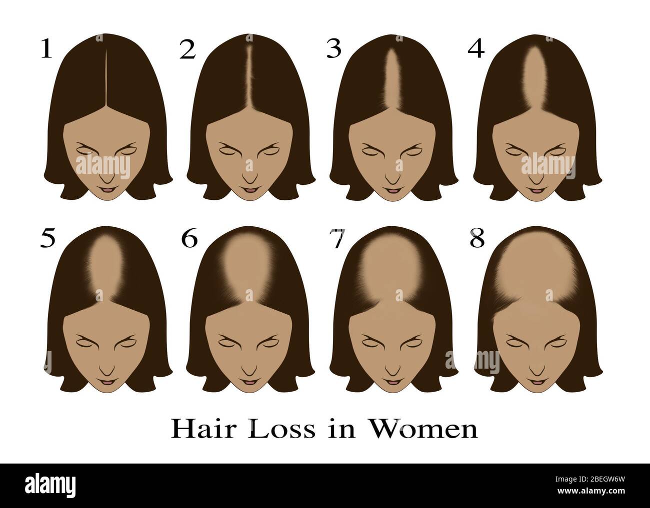 Female hair loss stages hi-res stock photography and images - Alamy