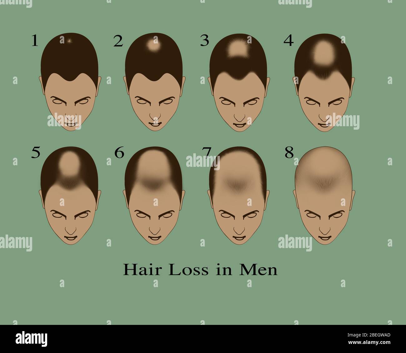 Male pattern baldness stages hi-res stock photography and images - Alamy