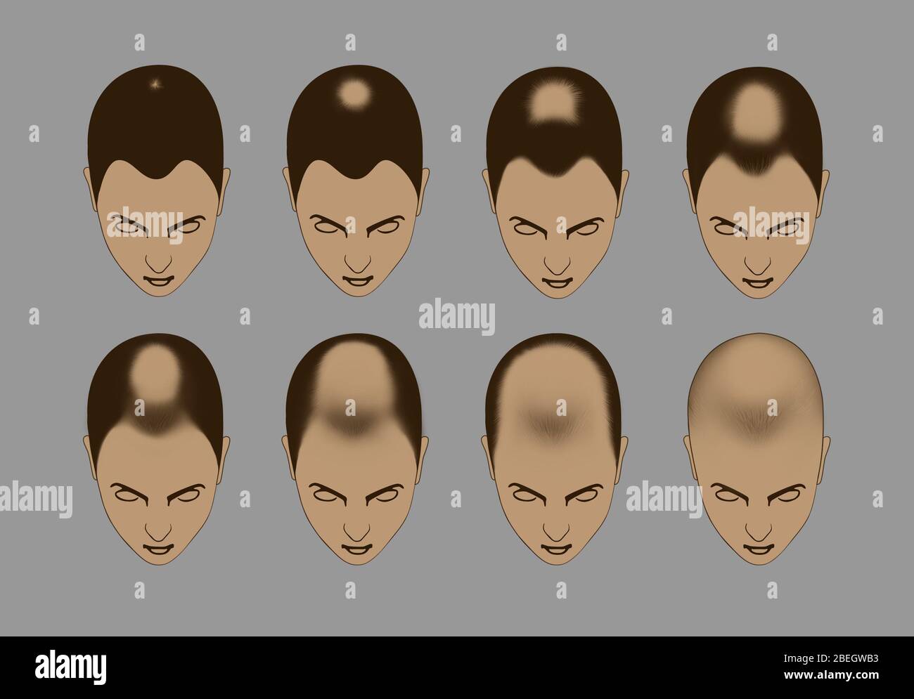 Hair loss illustration hi-res stock photography and images - Alamy