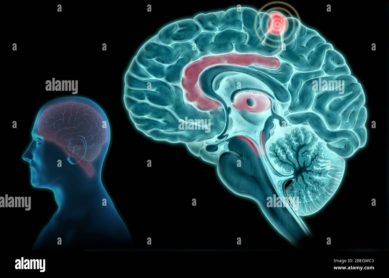 Brain pain not stroke not tumour hi-res stock photography and images ...