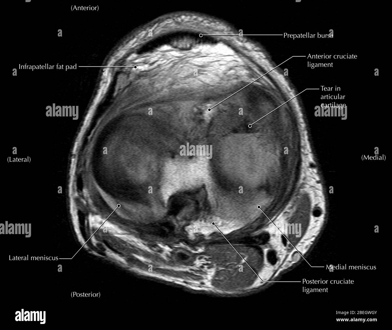 Knee Arthritis, MRI Stock Photo - Alamy