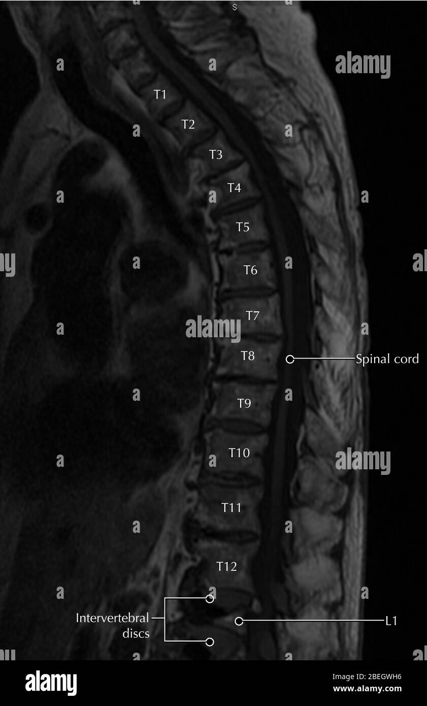 Lumbar Compression Fracture Stock Photo - Alamy