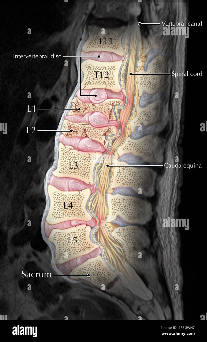 Lumbar Compression Fracture Stock Photo - Alamy
