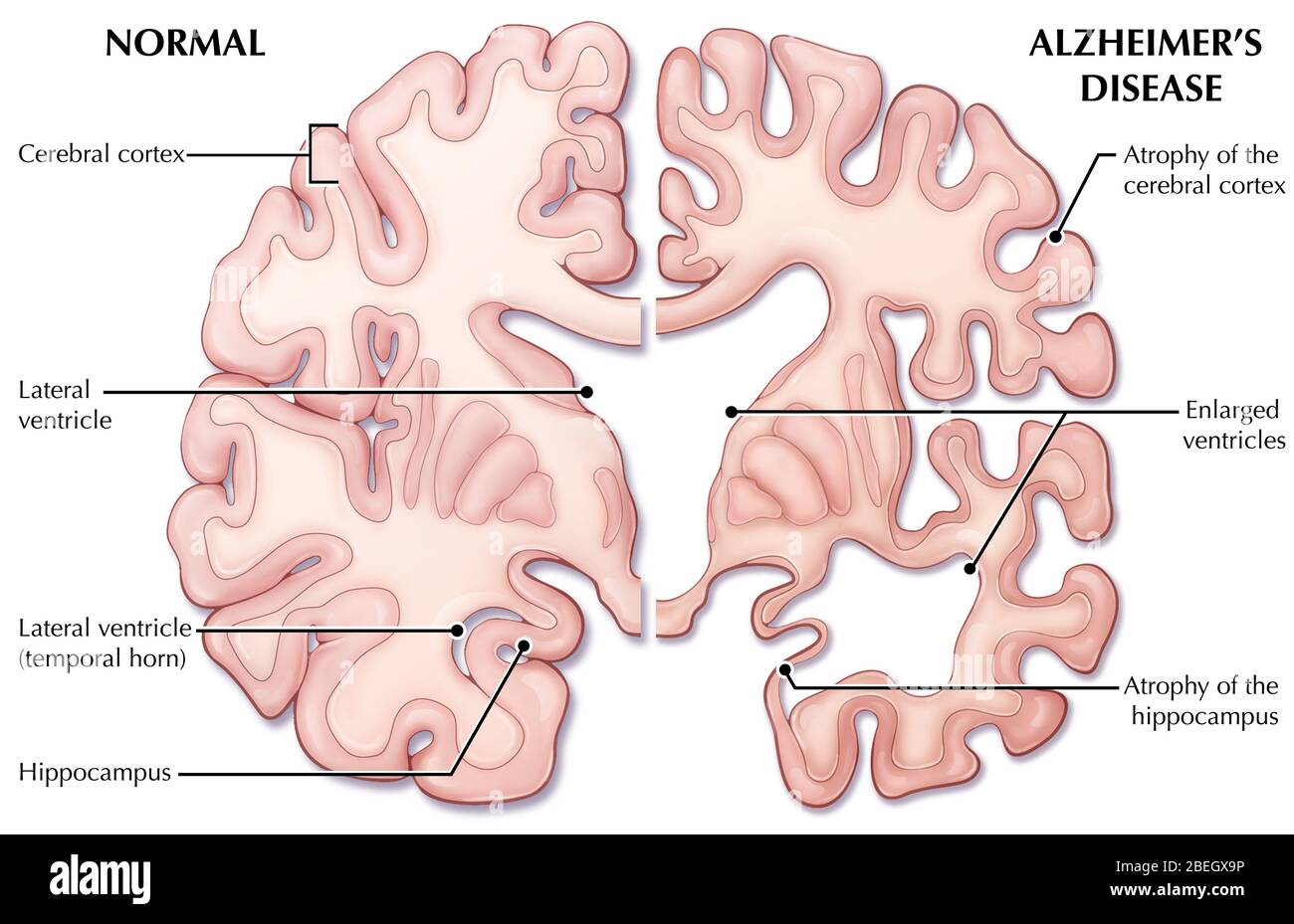Alzheimer S Disease Brain Mri Scan Stock Image C00414 - vrogue.co Alzheimer S Disease Brain Mri Scan Stock Image C00414 - vrogue.co