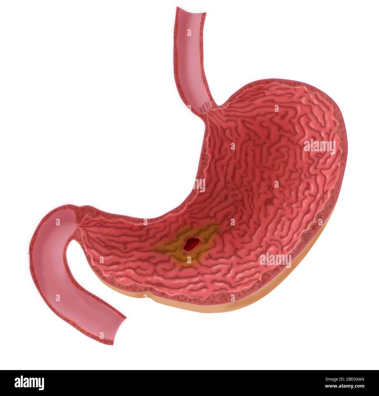 Anatomy ulcer Cut Out Stock Images & Pictures - Alamy