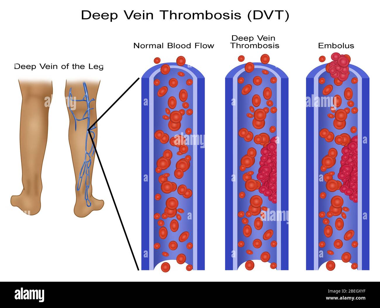 Dvt Leg High Resolution Stock Photography and Images - Alamy
